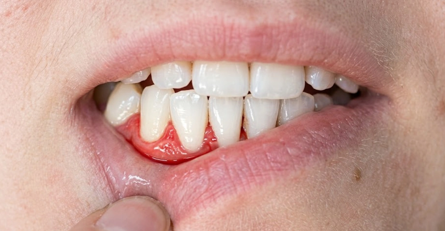 Why Is My Gum Swollen and Painful Around a Tooth? - Vitrin Clinic
