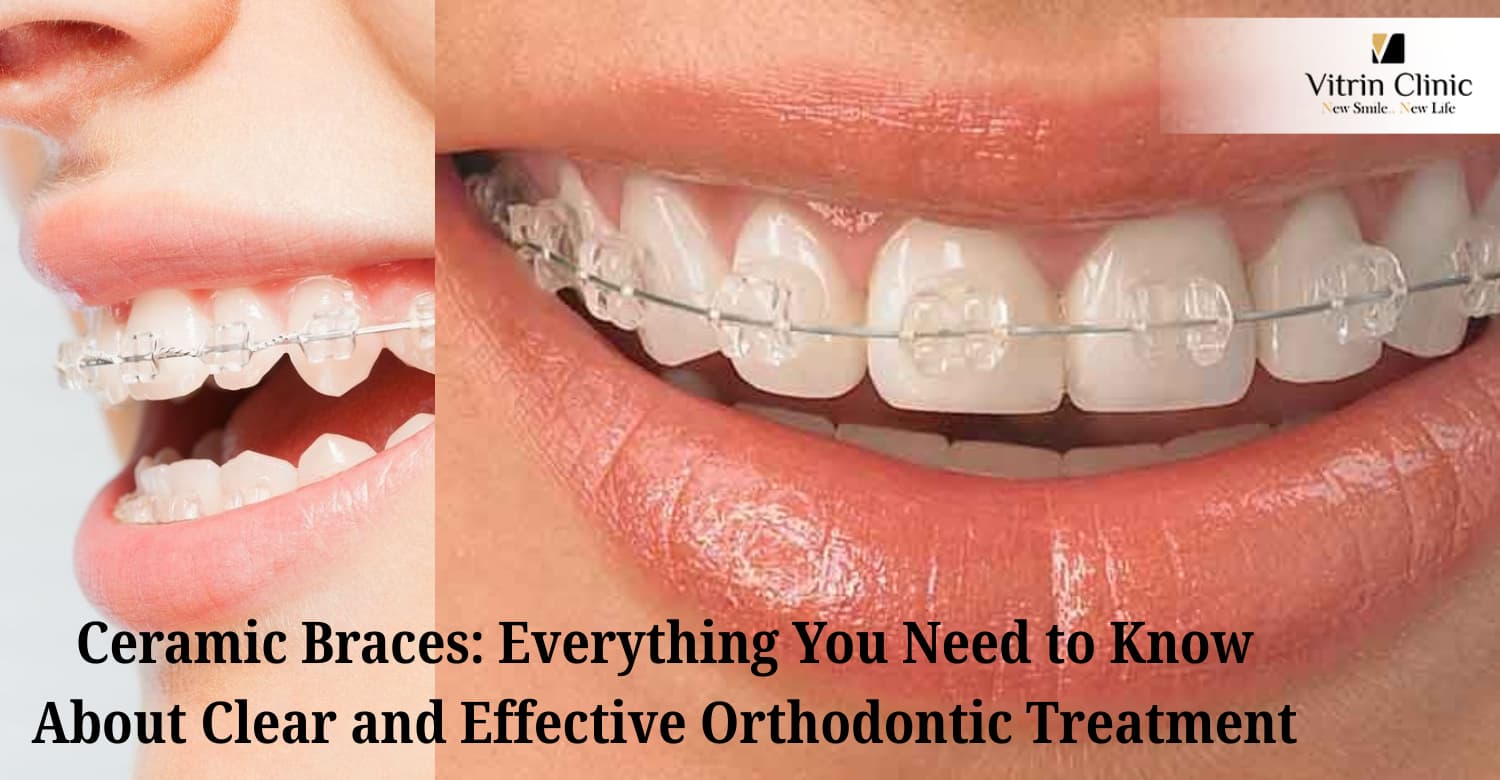 Ceramic Braces: Costs, Benefits & Expert Care - Vitrin Clinic